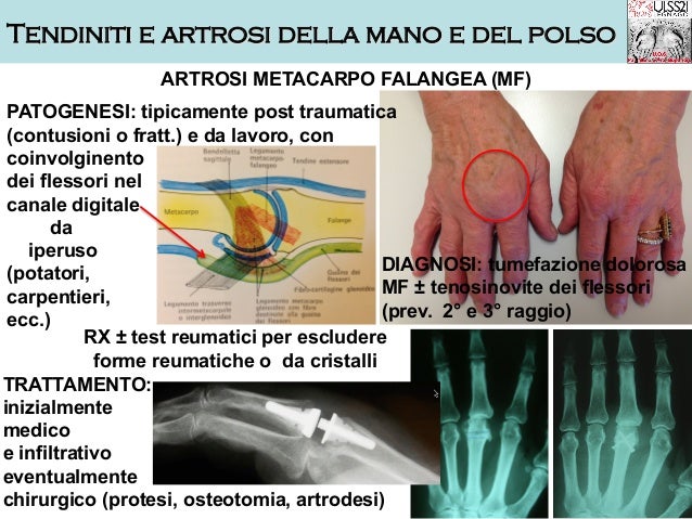 Tendiniti e artrosi della mano e del polso - Corso SPISAL Legnago 21/…