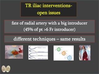 Cortese B - AIMRADIAL 2014 Endovascular - Iliac intervention | PPT