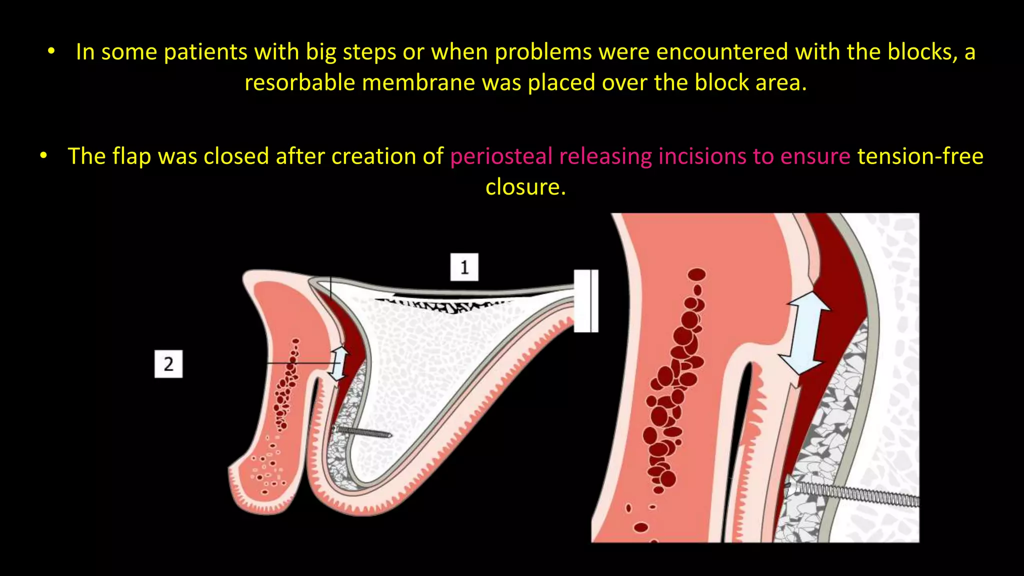 Cortical bone repositioning technique for horizontal alveolar bone ...