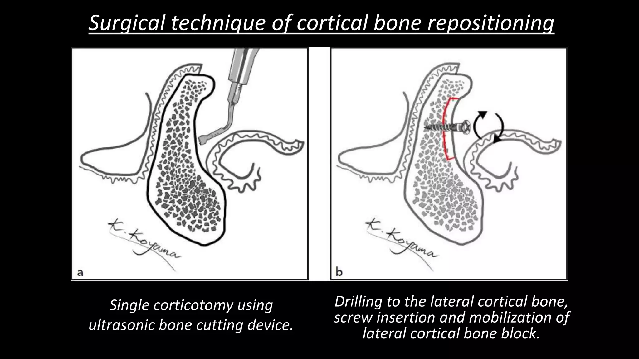 Cortical bone repositioning technique for horizontal alveolar bone ...