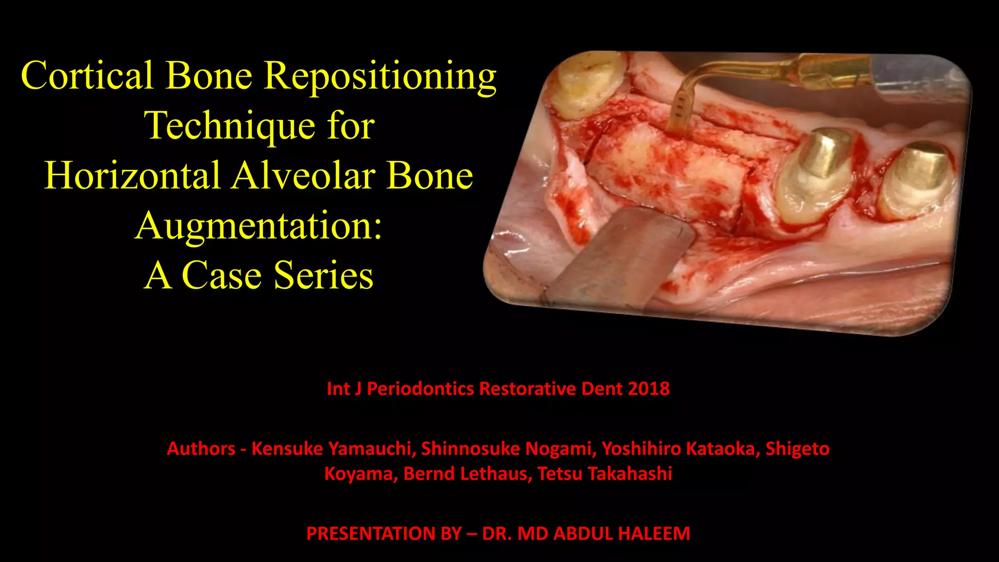 Cortical bone repositioning technique for horizontal alveolar bone ...