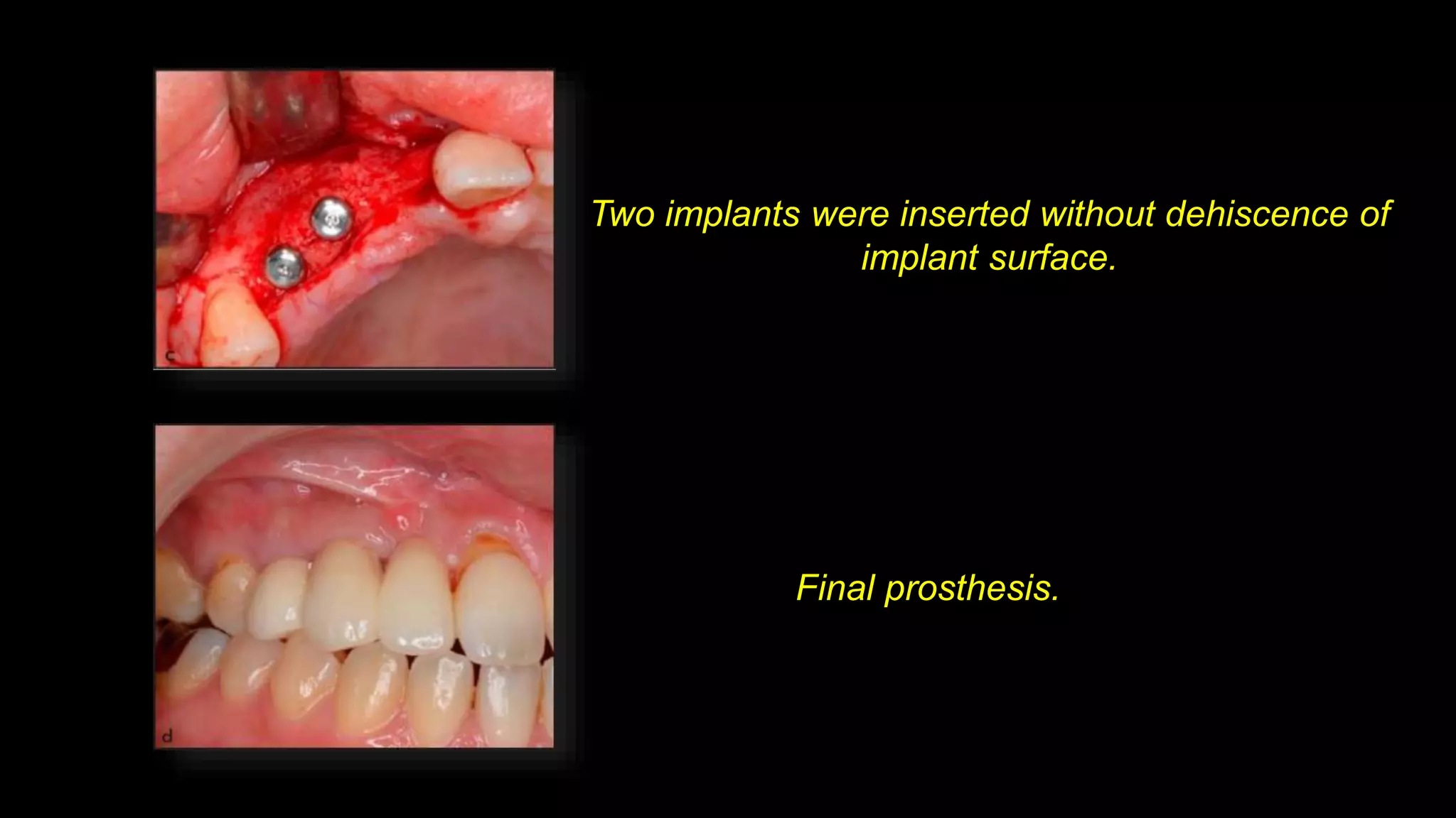 Cortical bone repositioning technique for horizontal alveolar bone ...
