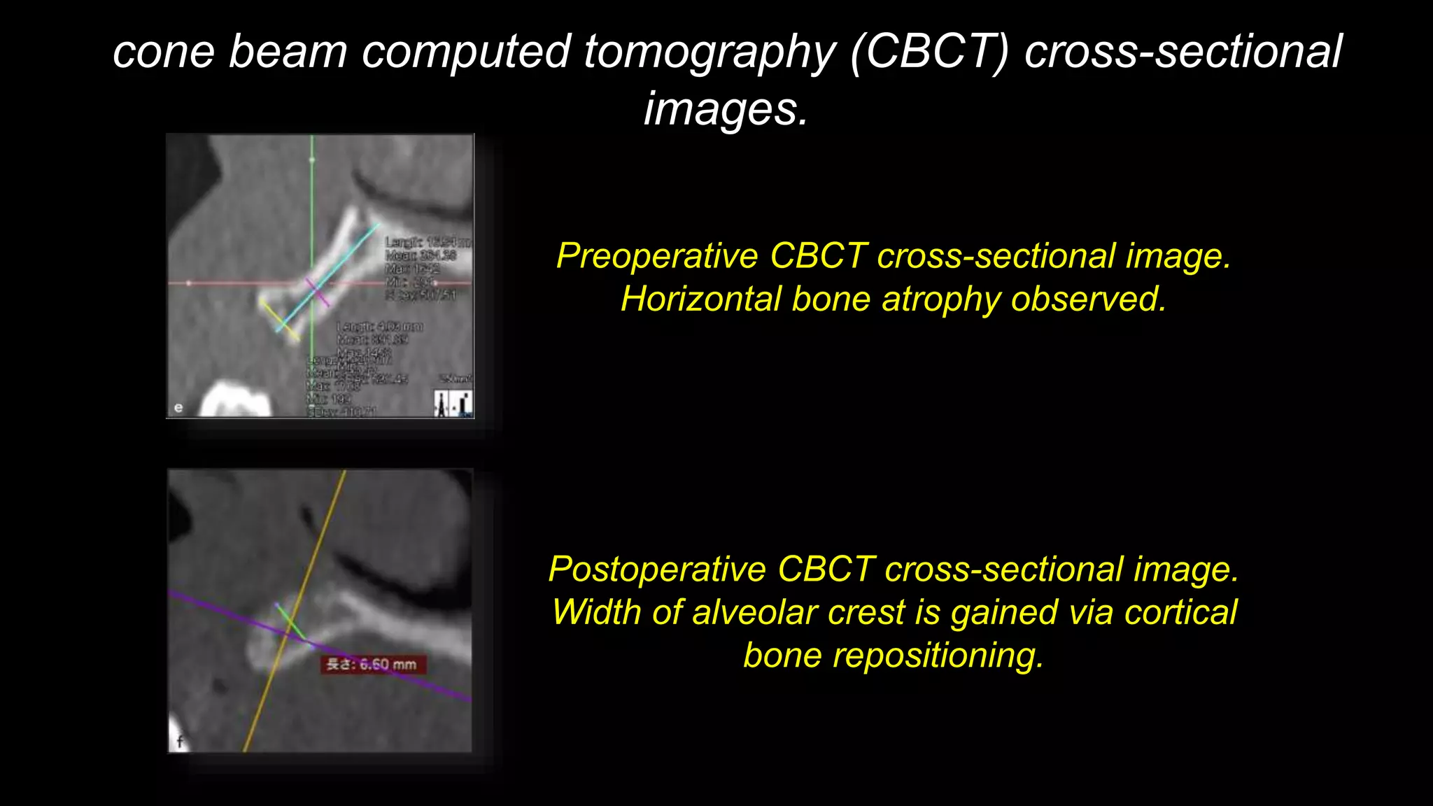 Cortical bone repositioning technique for horizontal alveolar bone ...