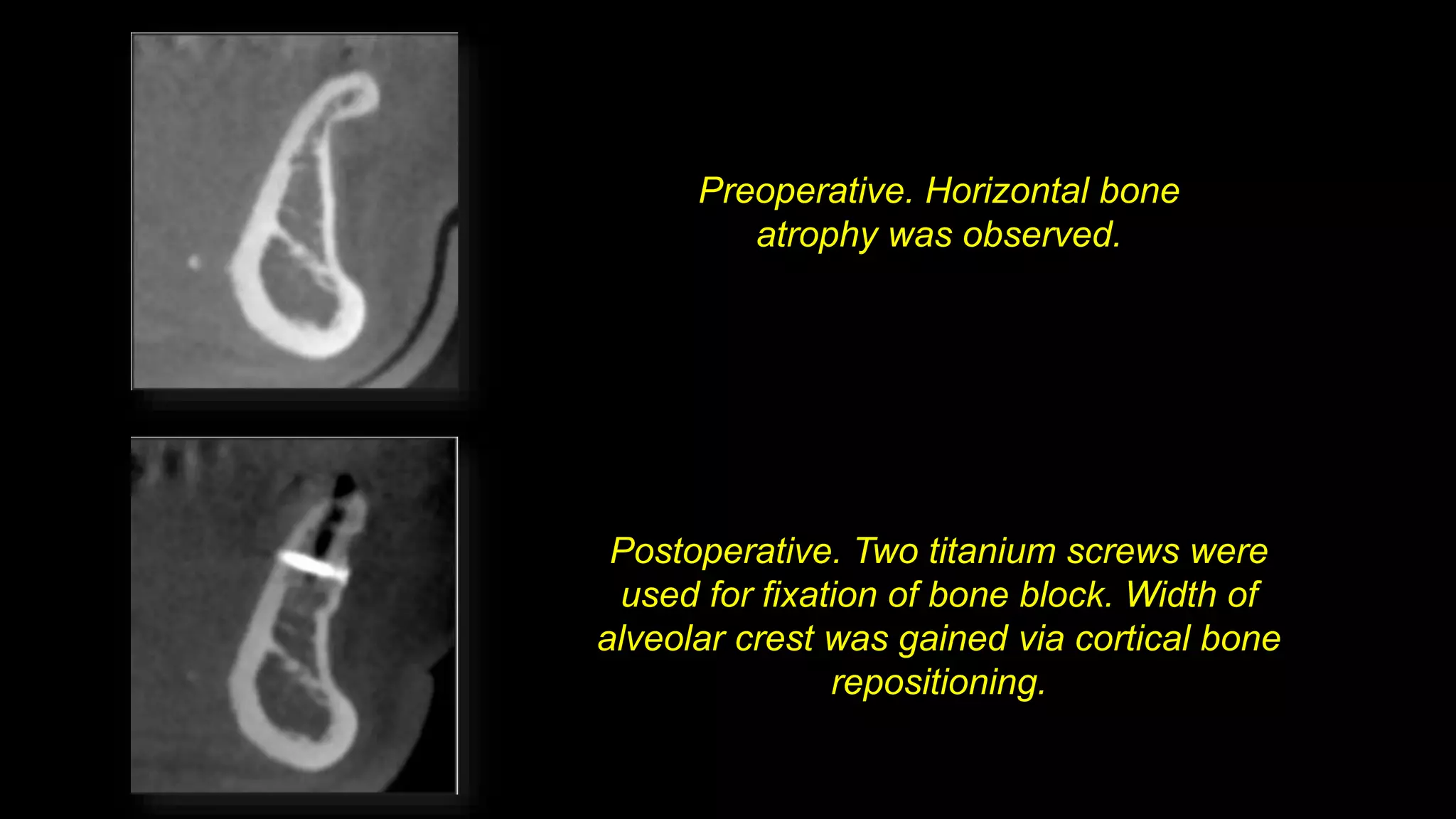 Cortical bone repositioning technique for horizontal alveolar bone ...