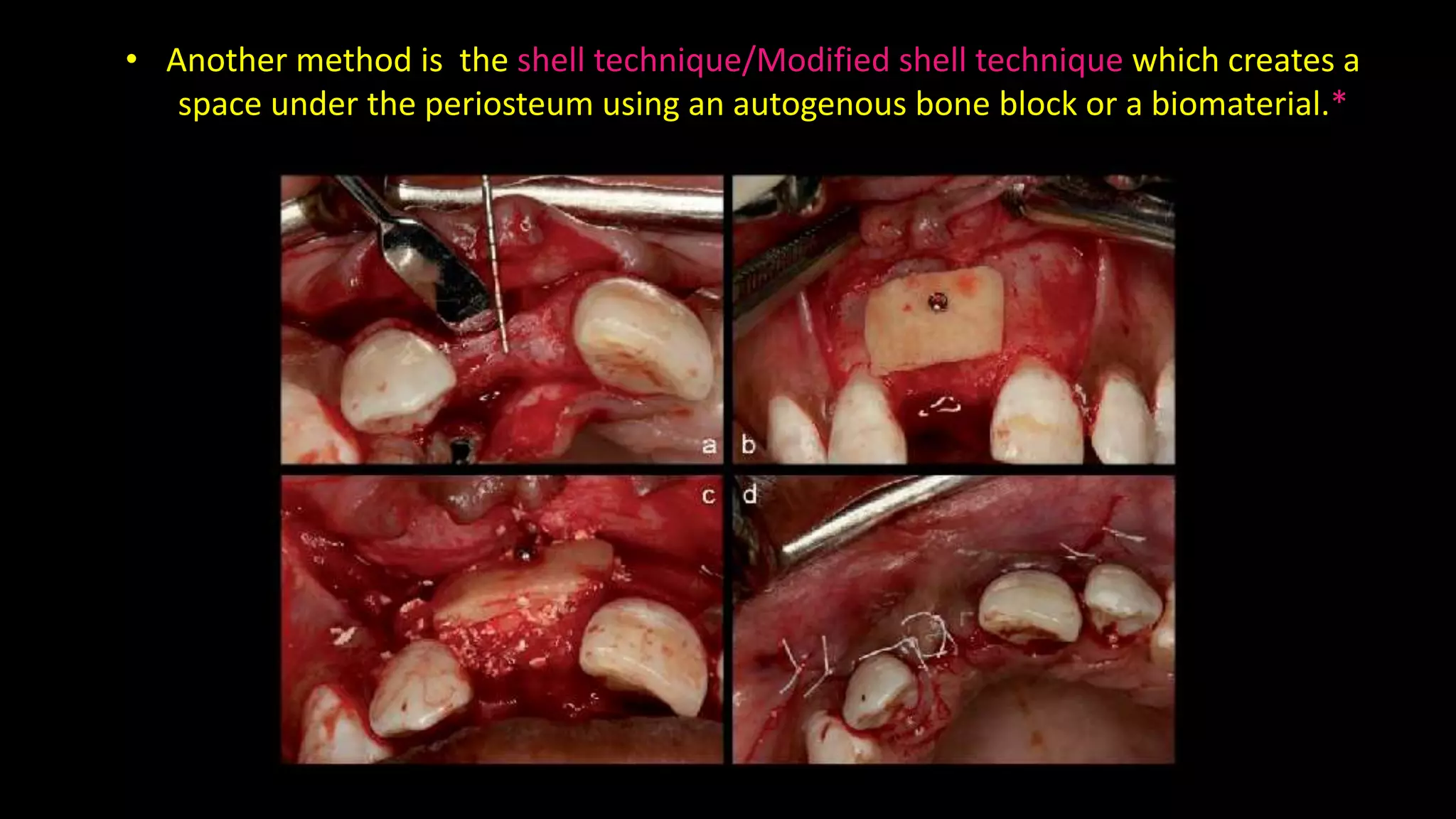 Cortical bone repositioning technique for horizontal alveolar bone ...