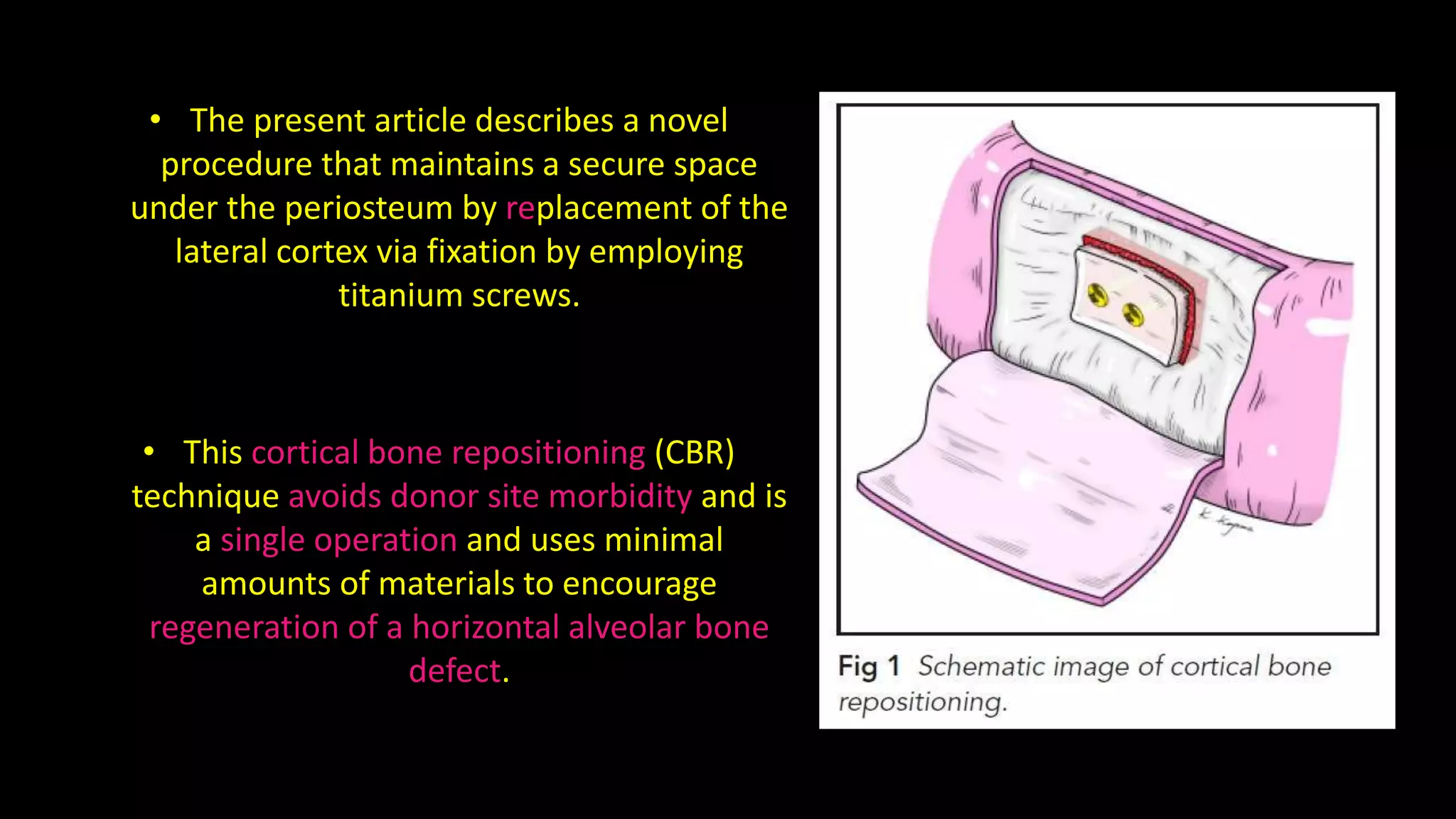 Cortical bone repositioning technique for horizontal alveolar bone ...