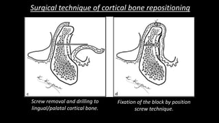 Cortical bone repositioning technique for horizontal alveolar bone ...