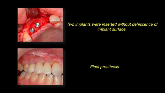 Cortical bone repositioning technique for horizontal alveolar bone ...