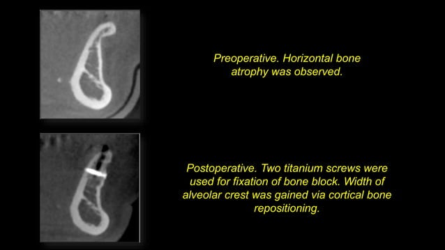 Cortical bone repositioning technique for horizontal alveolar bone ...
