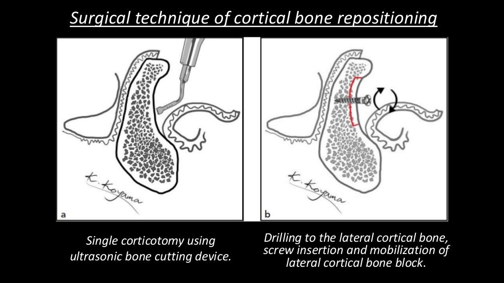 Cortical bone repositioning technique for horizontal alveolar bone au…