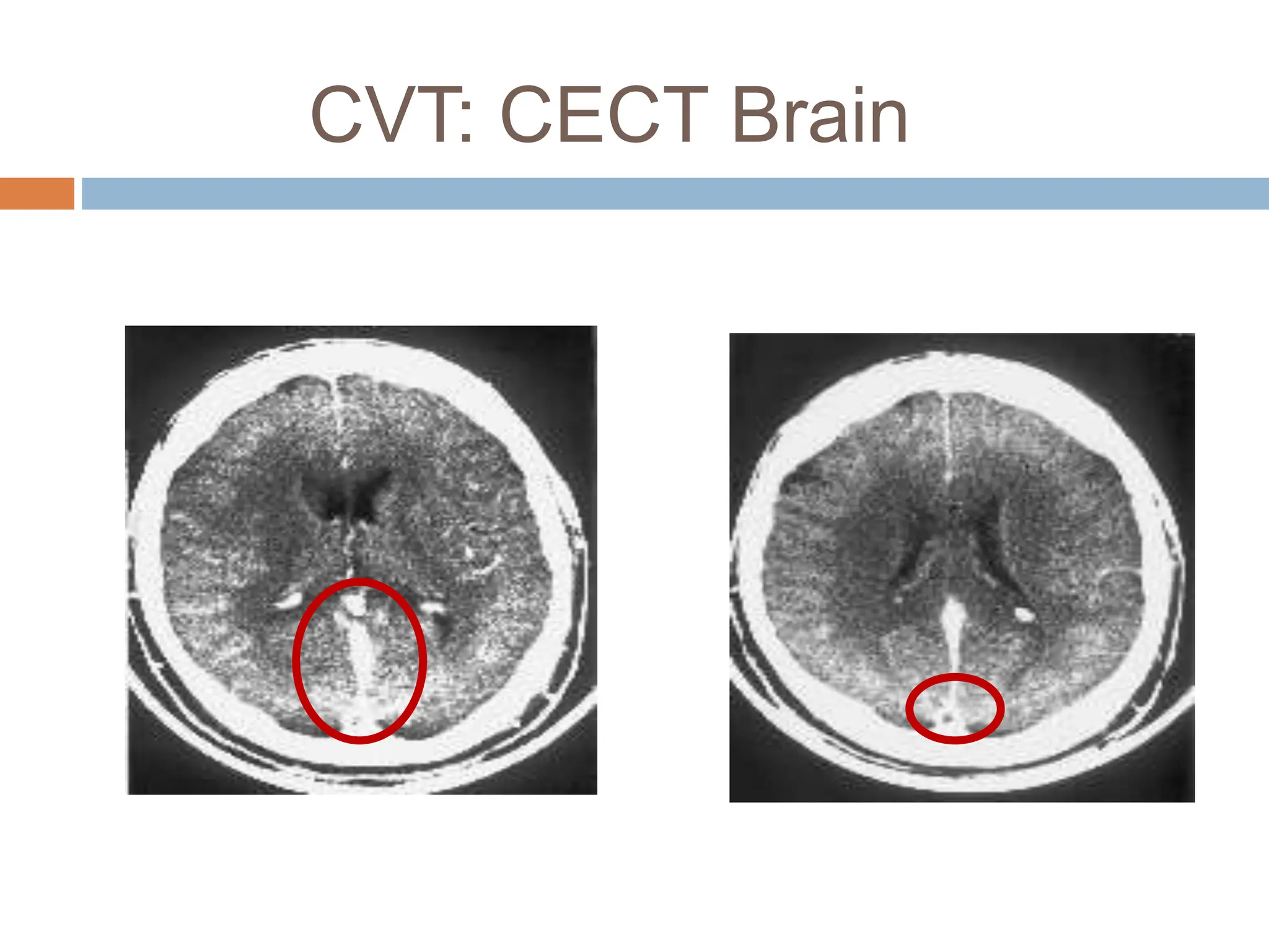 Cortical cerebral venous thrombosis (CVT) Management- Dr Ganesh.pptx