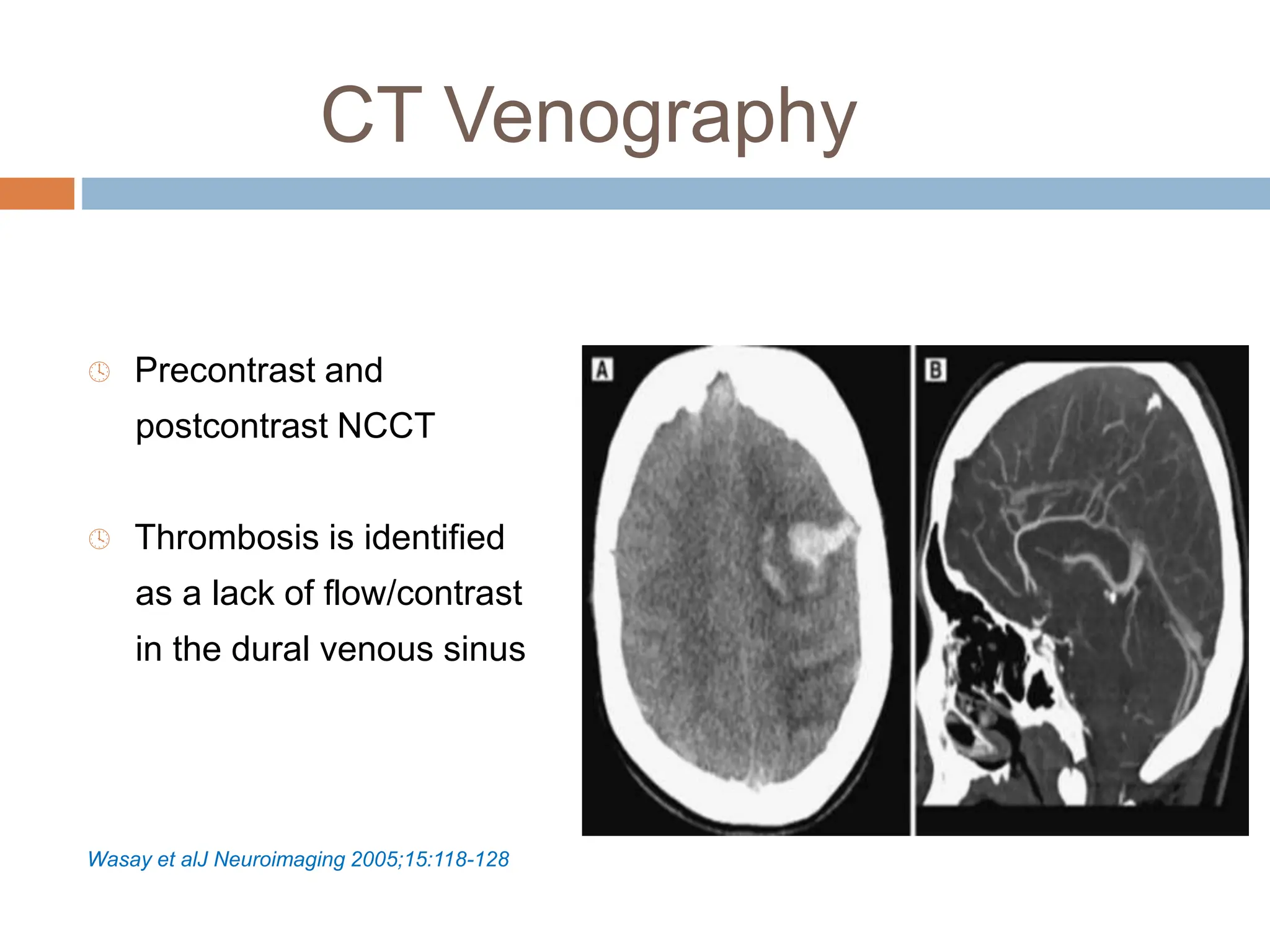 Cortical cerebral venous thrombosis (CVT) Management- Dr Ganesh.pptx
