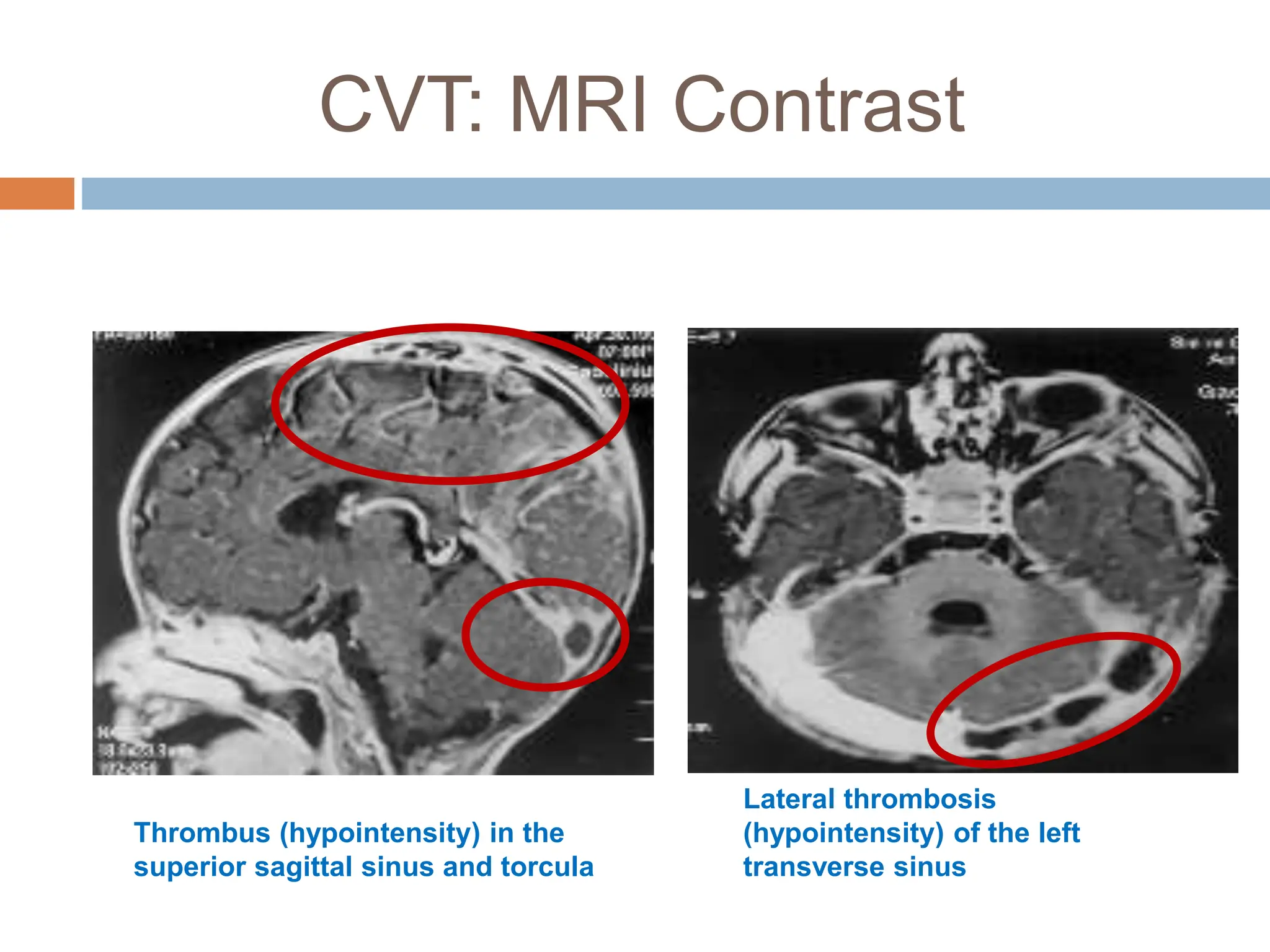 Cortical cerebral venous thrombosis (CVT) Management- Dr Ganesh.pptx
