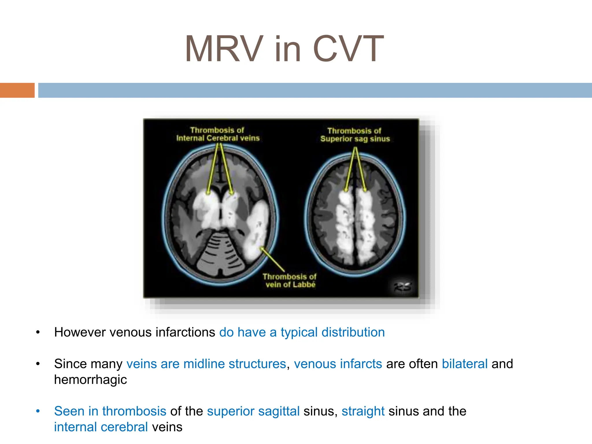 Cortical cerebral venous thrombosis (CVT) Management- Dr Ganesh.pptx