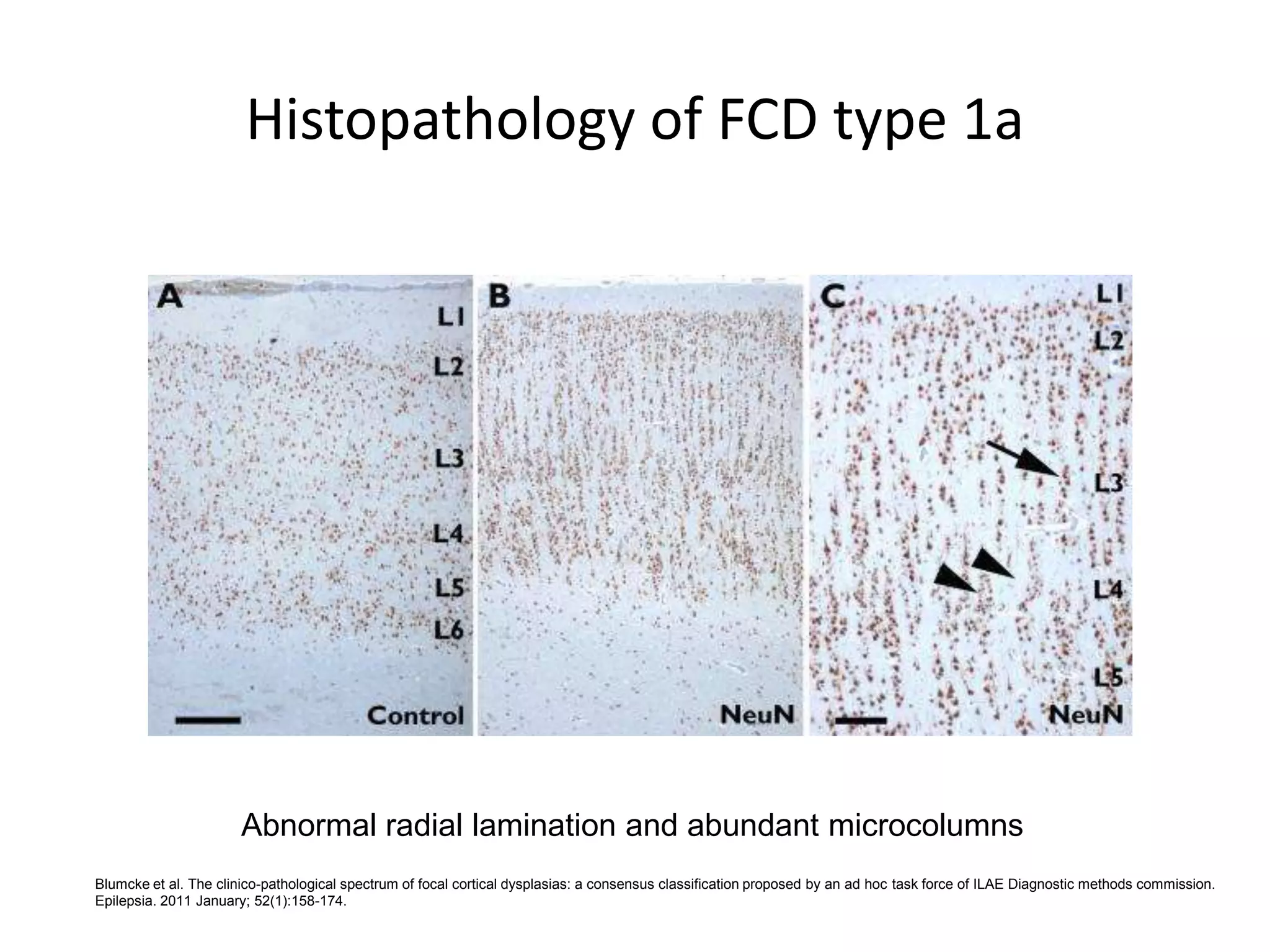 Cortical dysplasia | PPTX