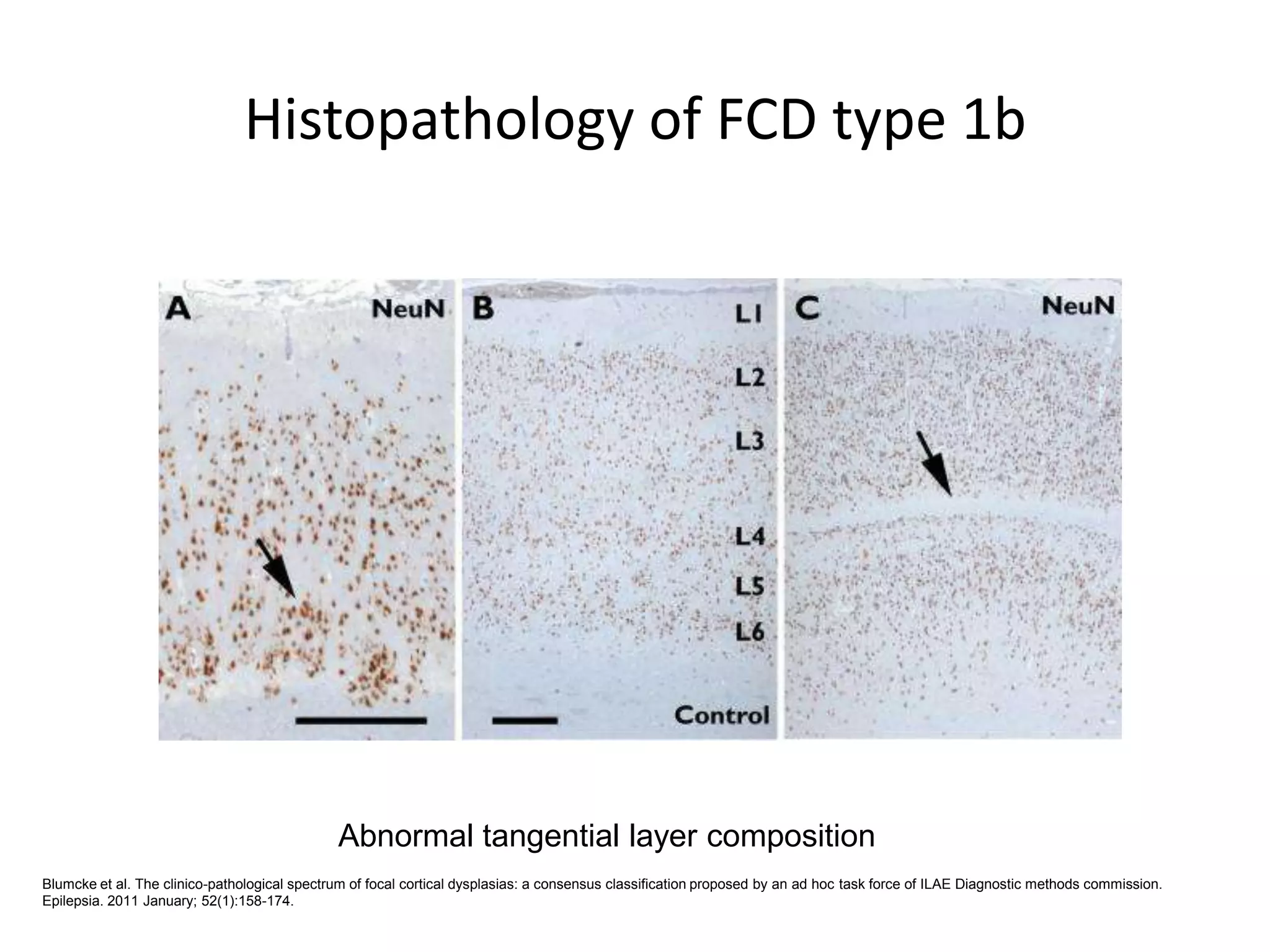 Cortical dysplasia | PPTX