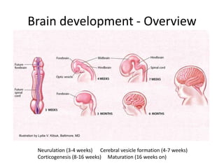 Cortical dysplasia | PPTX