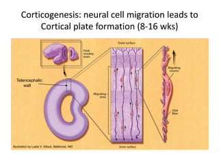 Cortical dysplasia | PPTX