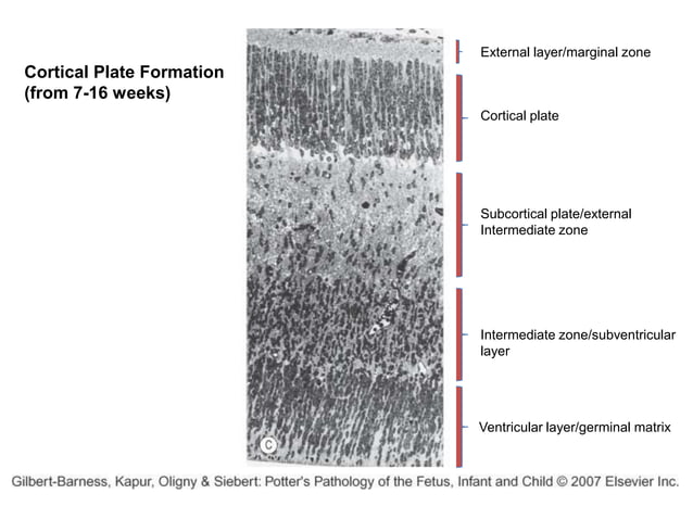 Cortical dysplasia | PPTX