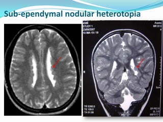 Cortical dysplasia and epilepsy | PPTX