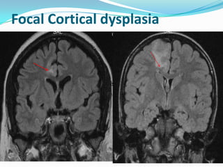 Cortical dysplasia and epilepsy | PPTX