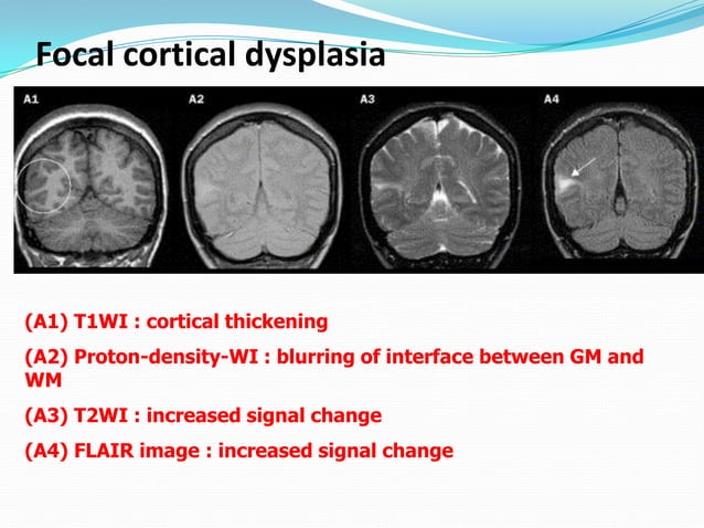 Cortical dysplasia and epilepsy | PPTX | Brain and Nervous System ...