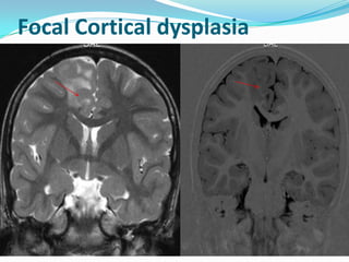 Cortical dysplasia and epilepsy | PPTX