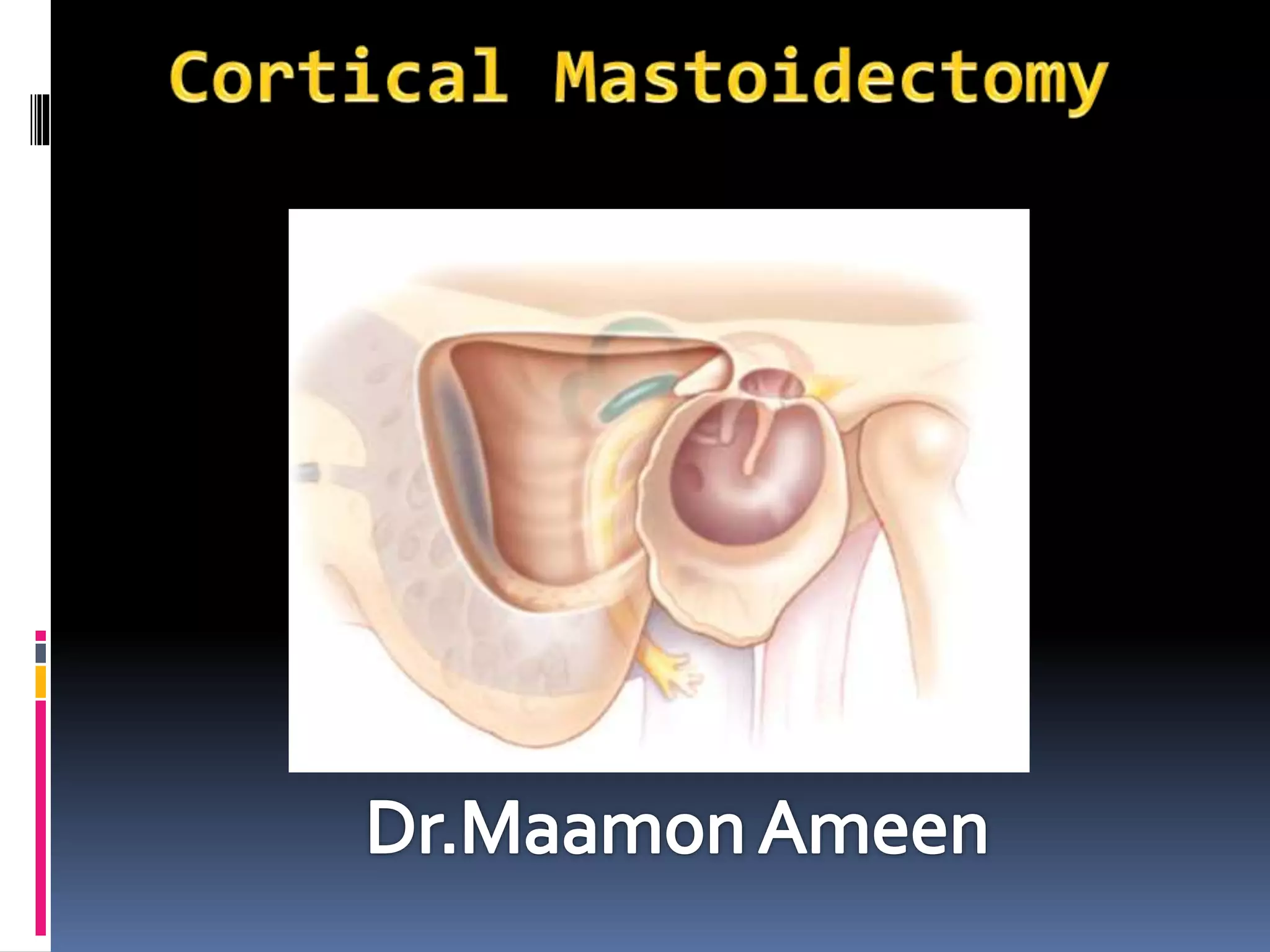 Cortical mastoidectomy | PPTX
