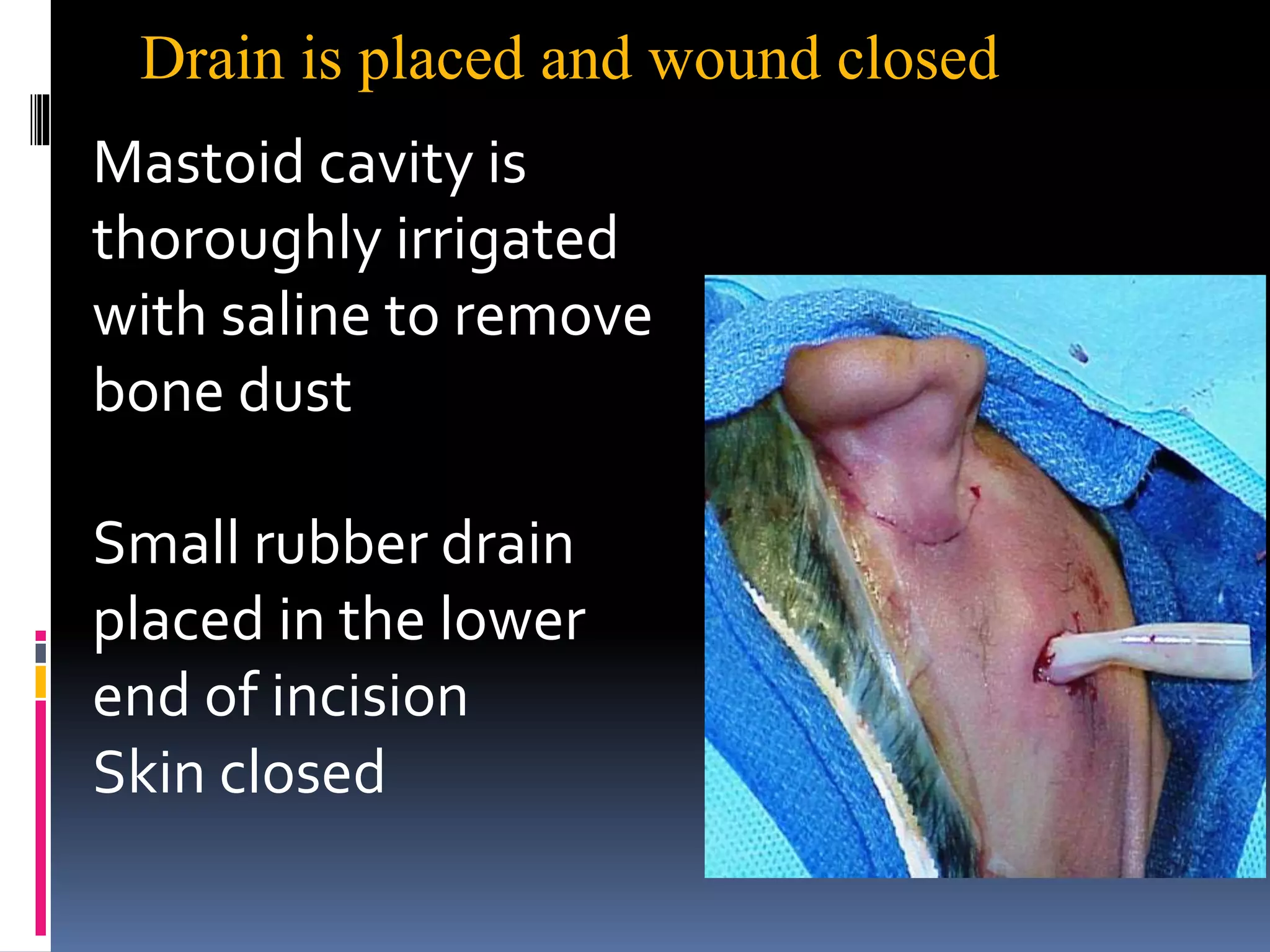 Cortical mastoidectomy | PPTX