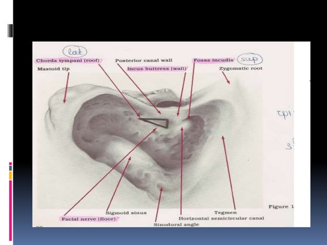 Cortical mastoidectomy | PPTX