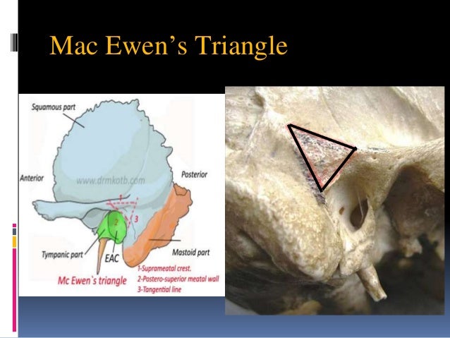 Cortical mastoidectomy