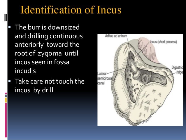 Cortical mastoidectomy