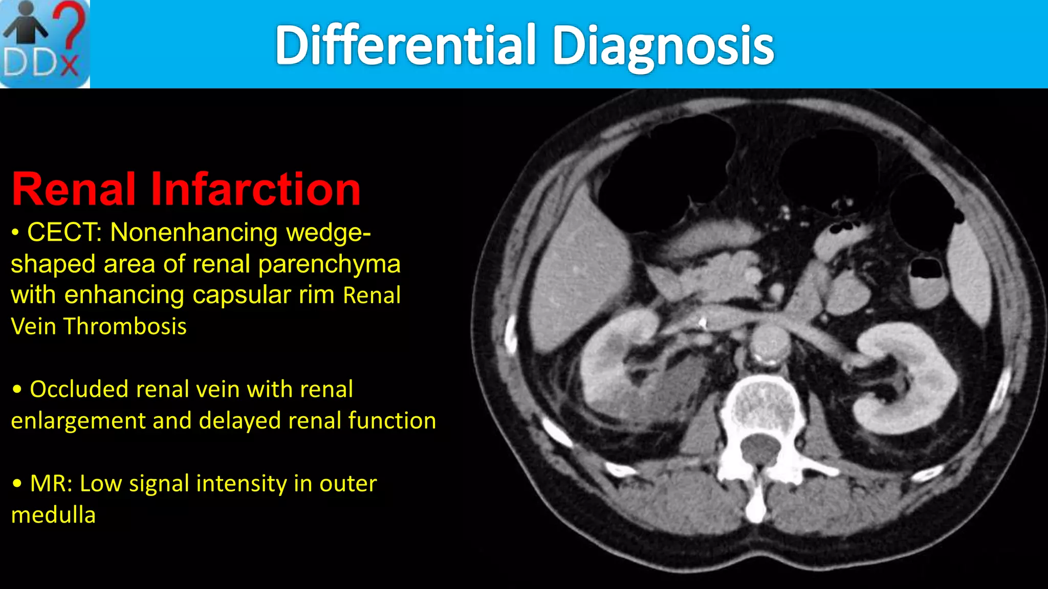 acute cortical renal necrosis | PPTX