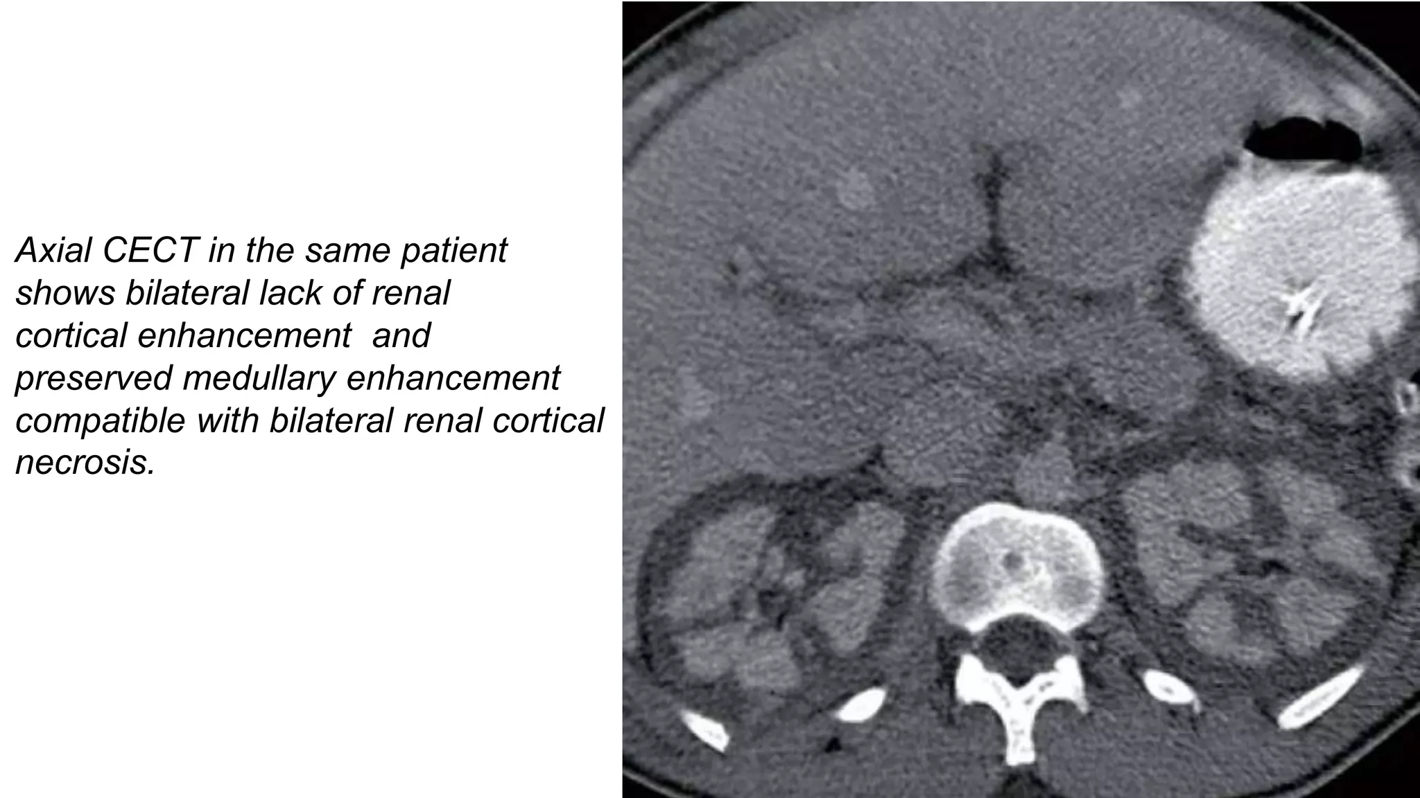 acute cortical renal necrosis | PPTX