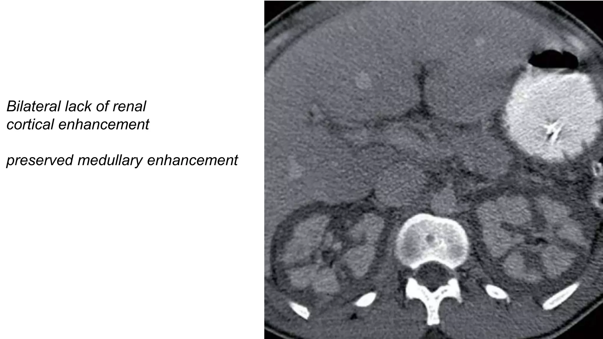 acute cortical renal necrosis | PPTX