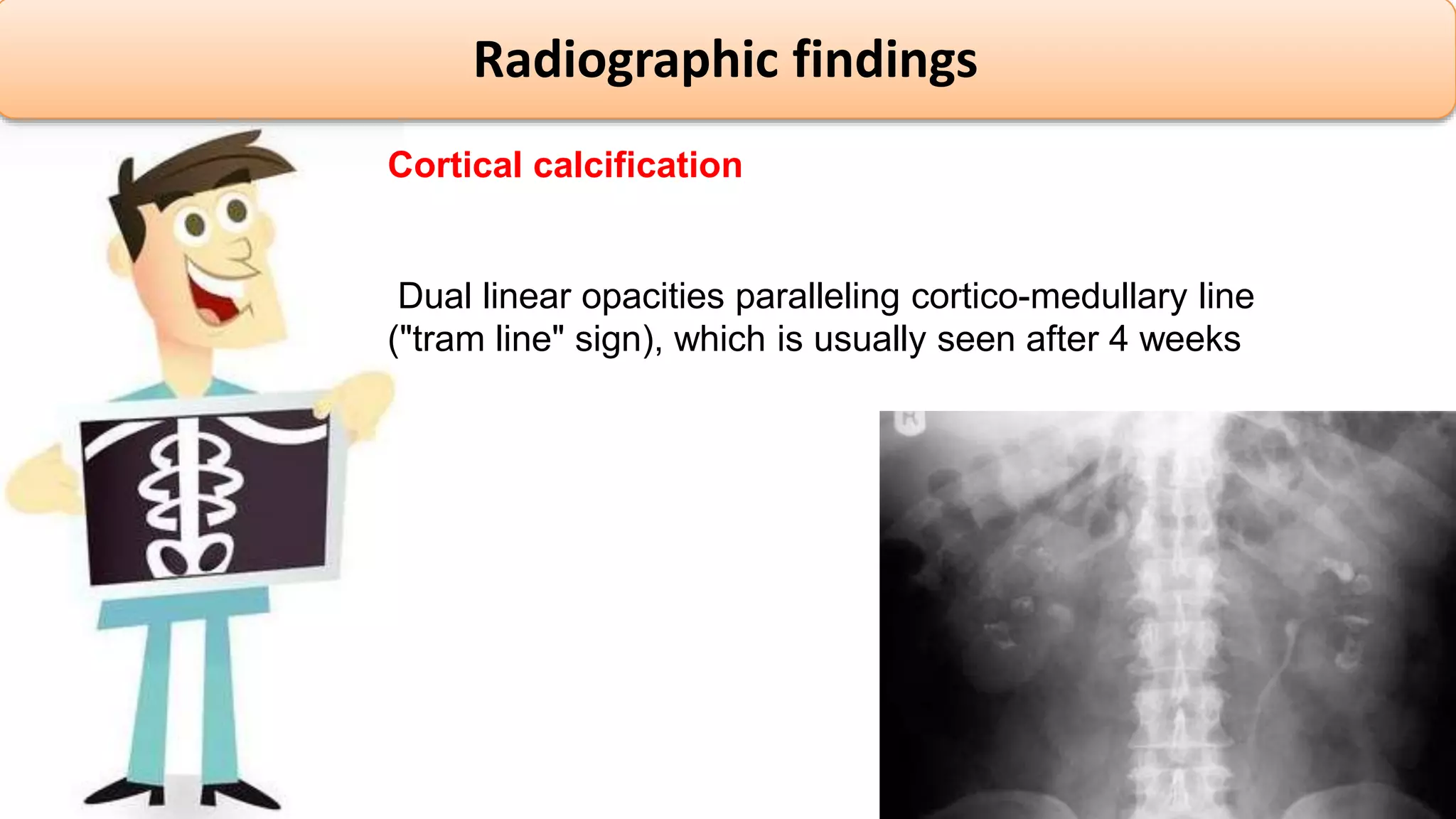 acute cortical renal necrosis | PPTX
