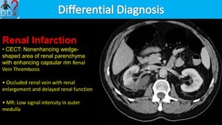 acute cortical renal necrosis | PPTX