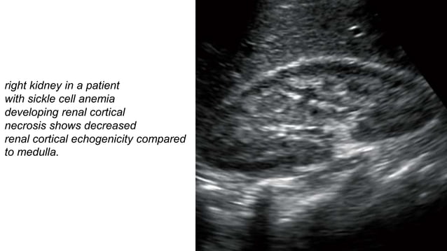 acute cortical renal necrosis | PPTX | Blood Disorders | Diseases and ...
