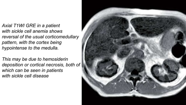 acute cortical renal necrosis | PPTX | Blood Disorders | Diseases and ...