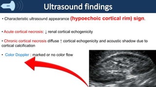 acute cortical renal necrosis | PPTX