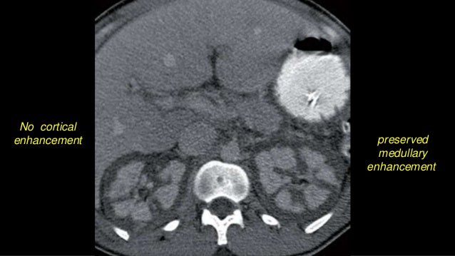 Acute Cortical Renal Necrosis