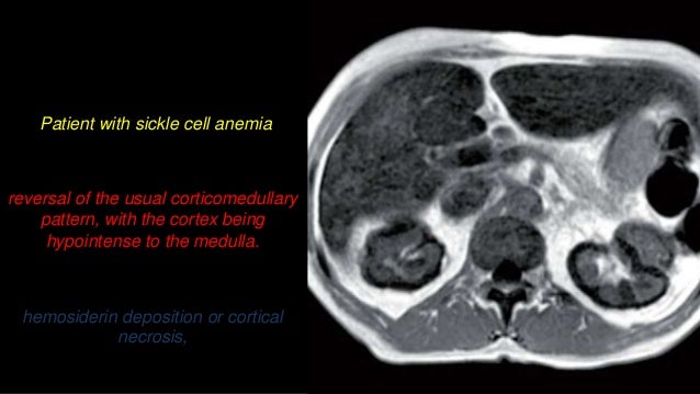 Acute Cortical Renal Necrosis