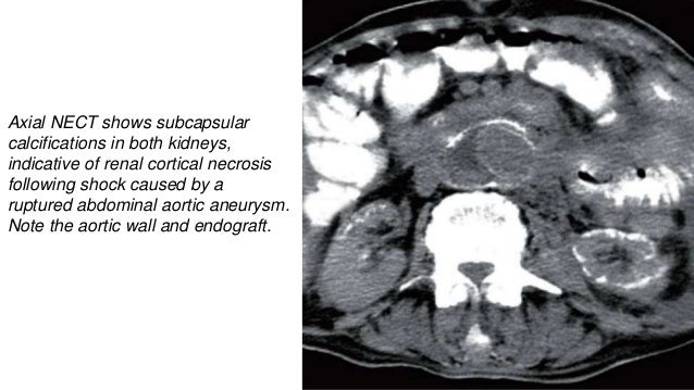 Acute Cortical Renal Necrosis