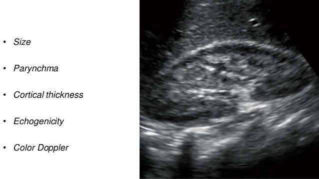 acute cortical renal necrosis