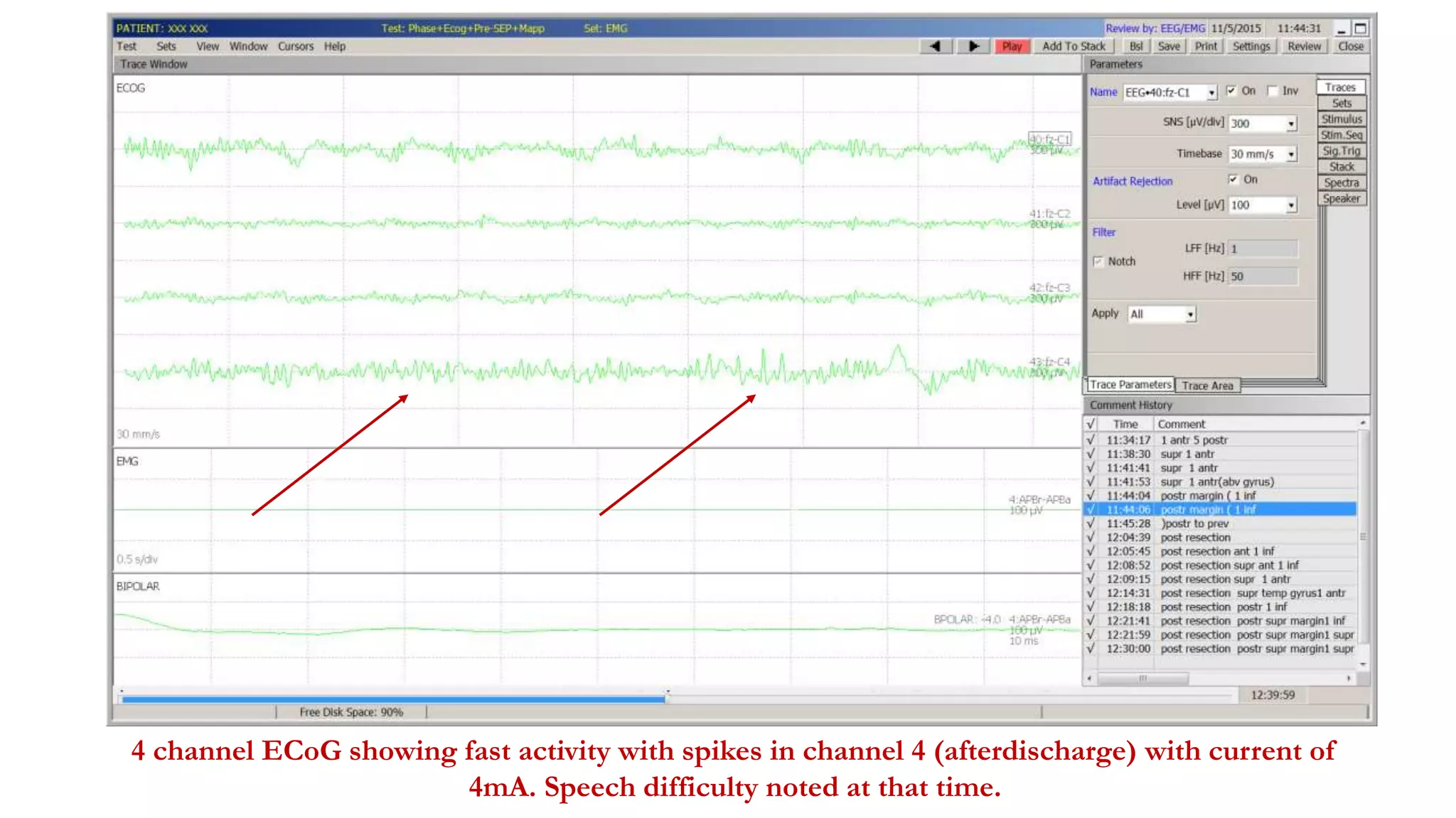 Cortical stimulation and mapping | PPTX