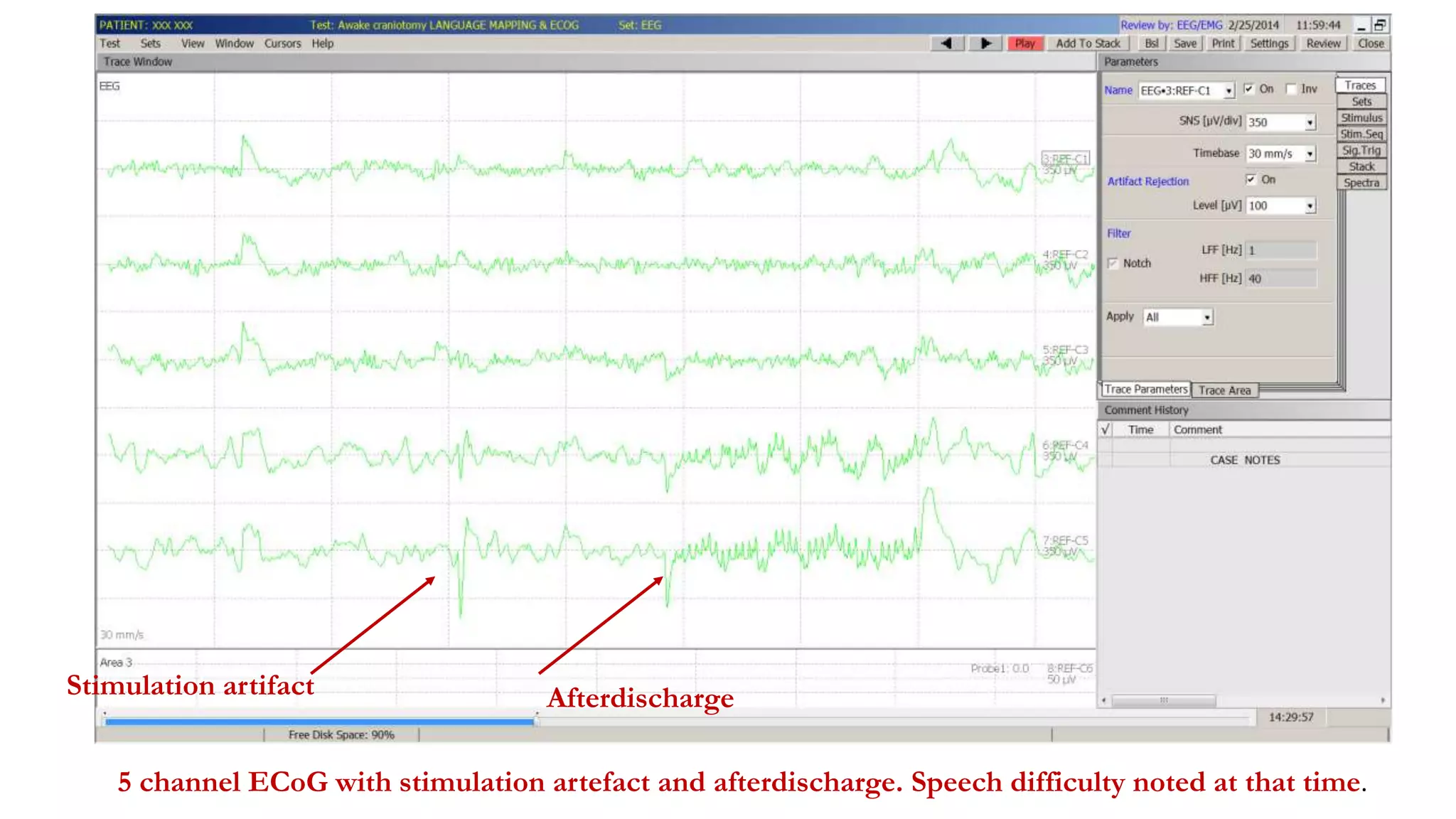 Cortical stimulation and mapping | PPTX