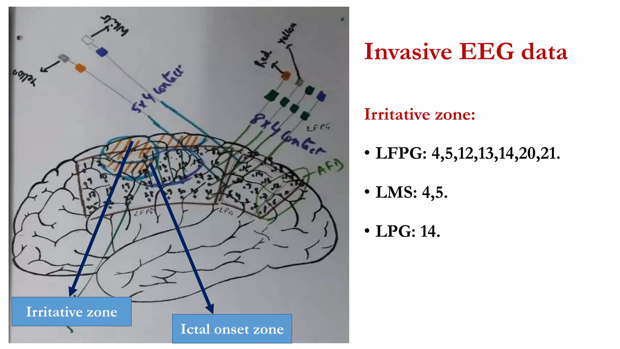 Cortical stimulation and mapping | PPTX