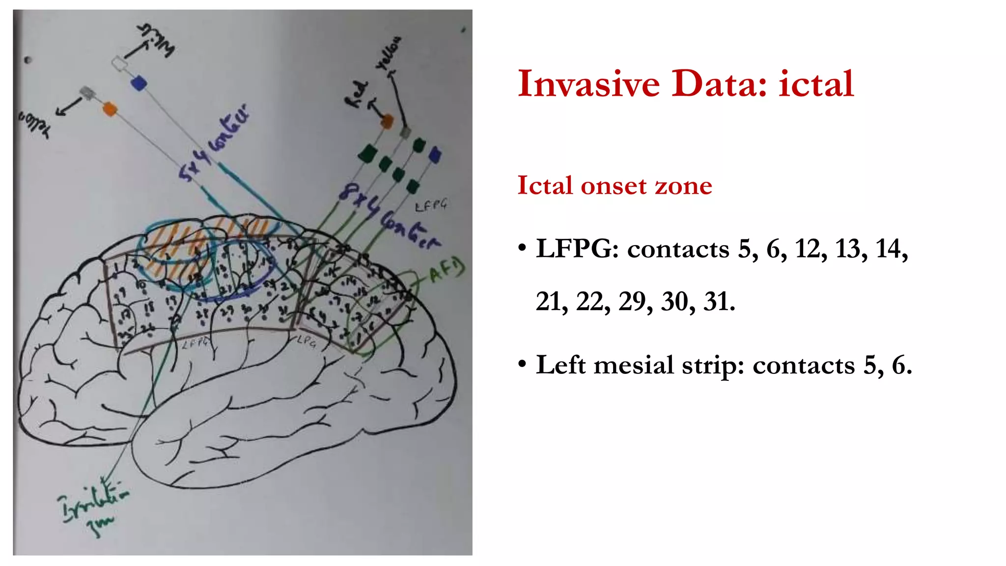 Cortical stimulation and mapping | PPTX