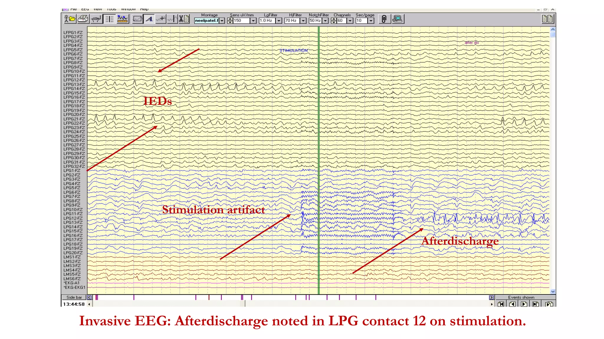 Cortical stimulation and mapping | PPTX | Brain and Nervous System Disorders | Diseases and ...