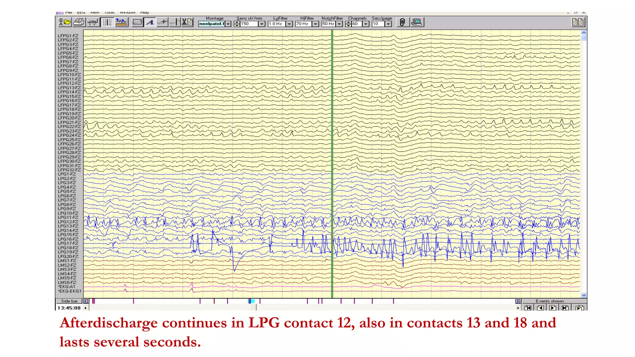 Cortical stimulation and mapping | PPTX